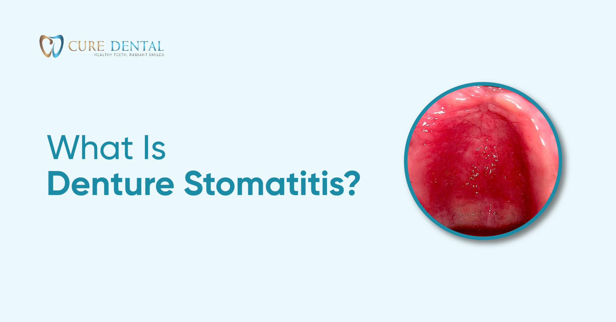 Denture Stomatitis: Understanding Causes and Prevention